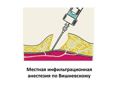 Местное обезболивание - презентация онлайн