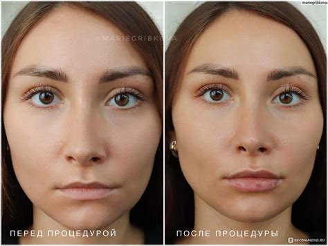 Филлер для губ Stylage Special Lips Lidocaine - «Моя первая инъекция ...
