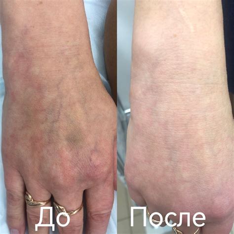 Склеротерапия вен нижних конечностей - цены в Новосибирске в клинике ...