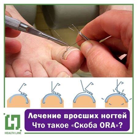 Коррекция вросших ногтей с помощью титановой нити