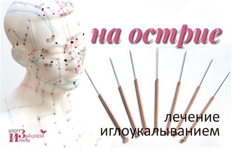 Иглоукалывание. Лечение. Польза и вред. Противопоказания. Отзывы