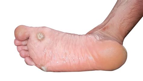 What Are Heloma Durum Causes?