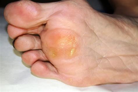 What is callus, and how is it treated? - Exnol