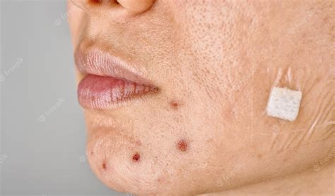 Premium Photo | Facial skin problem acne disease in adult close up woman face with whitehead ...