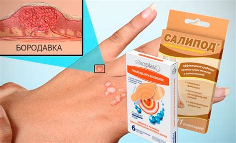 Пластырь от папиллом: обзор, инструкция по применению, отзывы об ...