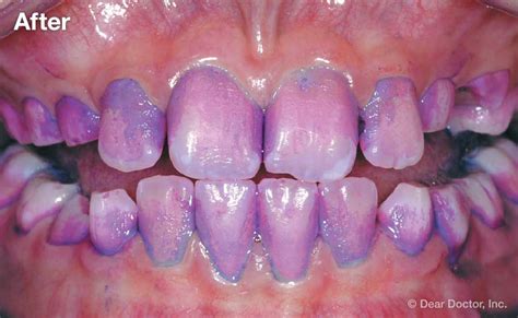 Plaque Disclosing Agents