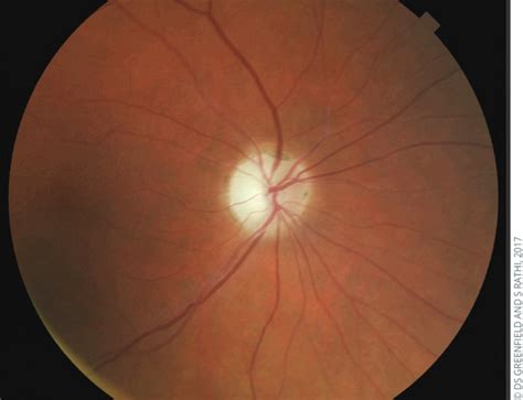 Optic neuropathies that mimic glaucoma. - Abstract - Europe PMC