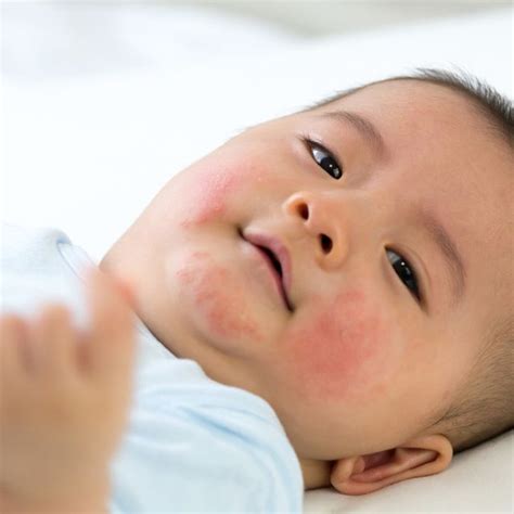 cara mengatasi alergi kulit bintik merah pada bayi - Jack Davies