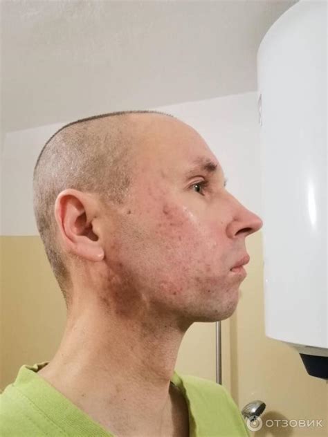 Отзыв о Косметика Libre Derm | Лучшее средство при Розацеа и Акне.