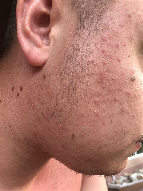 Prickly Heat : r/popping