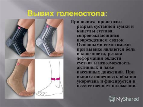 Презентация на тему: "Что такое « вывих »; выясните причины ...