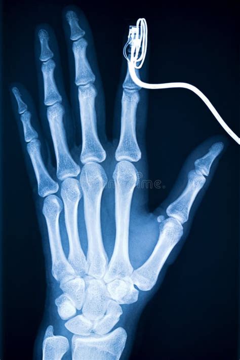 Xray_1 stockfoto. Bild von medizinisch, doktor, krankenhaus - 12219546