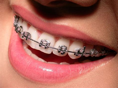 Ортодонтія в Києві: ціна на брекети - стоматологічна клініка Alex Dental