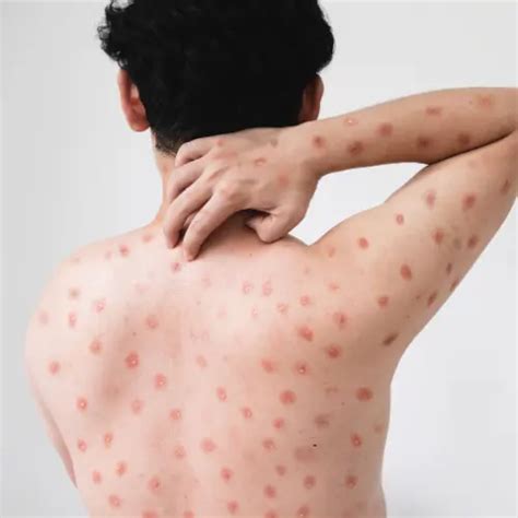 Can You Die From Monkeypox (MPOX) Virus? - MONKEYPOX (MBOX) VIRUS