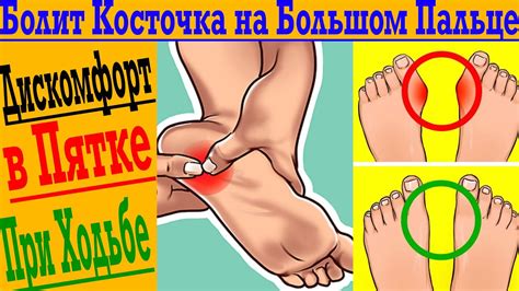 Болит косточка на большом пальце ноги! Дискомфорт и боль в пятке когда ...