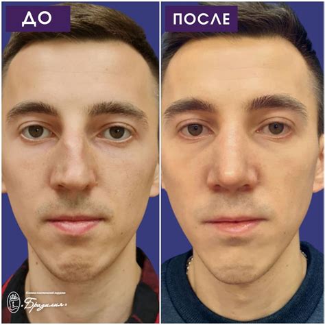 Ринопластика, пластика носа цена и отзывы в Калининграде