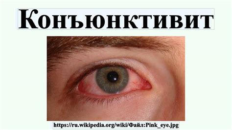 Конъюнктивит - YouTube