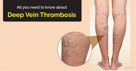 Deep vein thrombosis - Symptoms, Causes and Treatment | Skedoc