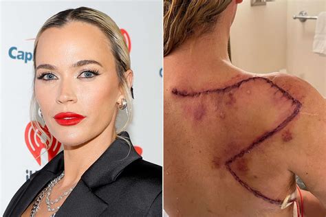 Teddi Mellencamp Says Her Melanoma Is Gone After Surgery
