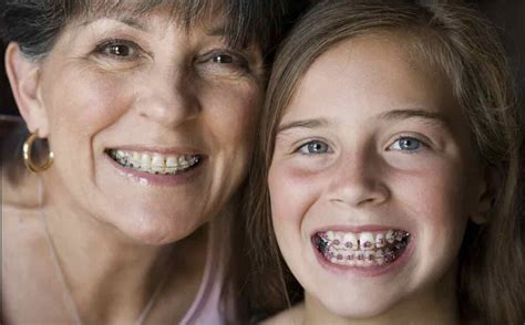 Що потрібно знати про металеві брекети - Cтоматологія Dentalknysh