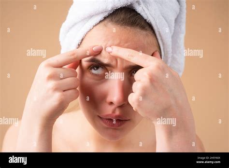 Close up woman squeezing pimples on her face. Acne blemish spots skin on young woman. Spot scar ...