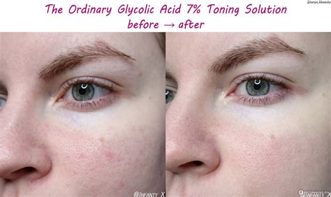 Тоник для лица The Ordinary Glycolic Acid 7% Toning Solution ...