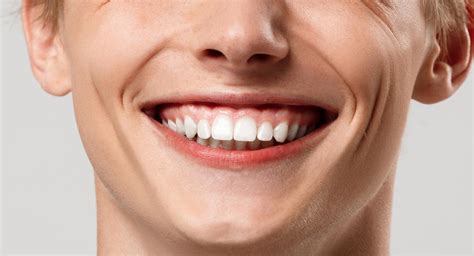 Gummy smile Behandlung mit Botulinumtoxin in Zürich