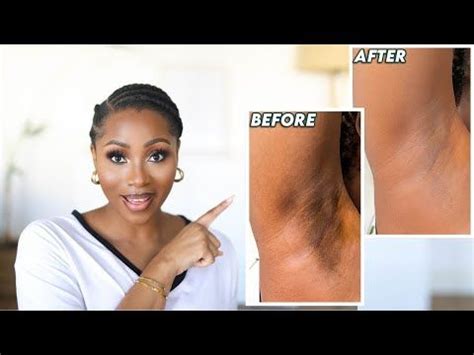 How i got rid of my dark underarms how to brighten your armpits keep ...