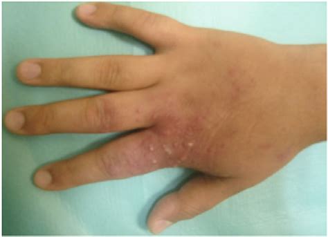 Improvement of lesions after 10 days of Glucantime treatment ...