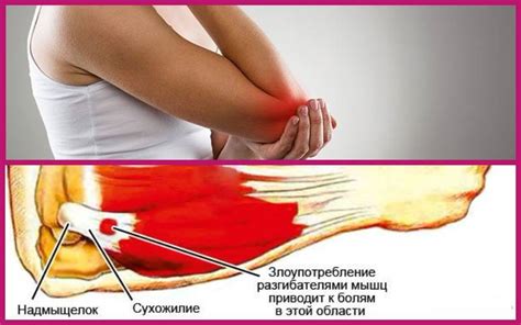 Воспаление сухожилий (тендинит): что это такое, лечение связок ...
