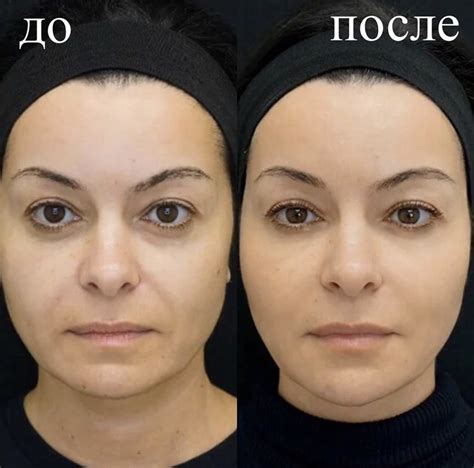 Эстефил (Aesthefill) - контурная пластика филлером на основе ...