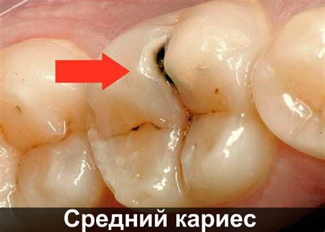 Образовался средний кариес | Взубе.ком