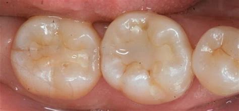 Цементные зубные пломбы - Энциклопедия стоматологии DentalMechanic.ru