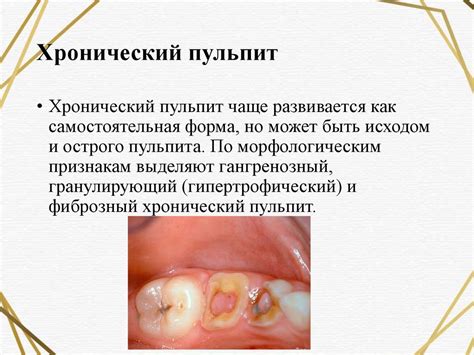 Пульпит. Классификация пульпита - презентация онлайн