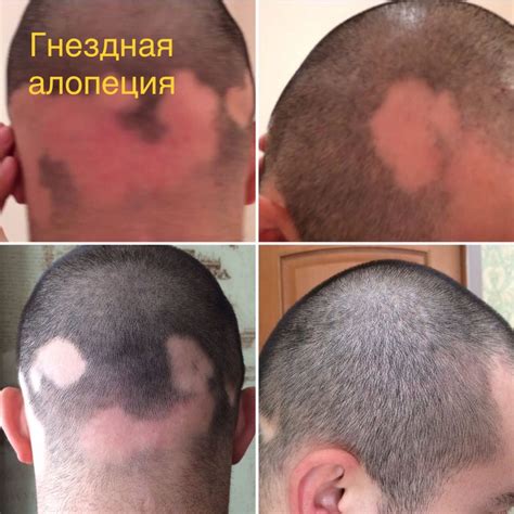 Как лечить алопецию у мужчин? Причины алопеции, видео