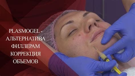 💉Моделирование носогубных складок ПЛАЗМОГЕЛЬ | PLASMOGEL идеальный ...