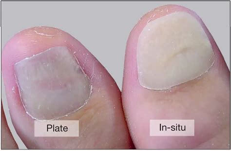 GREPPMAYR START-SET Unguisan Start Set Nail Reconstruction Instruction ...