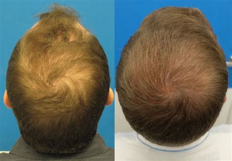 Пересадка волос в Латвии | Hair transplant, Hair, Hairline