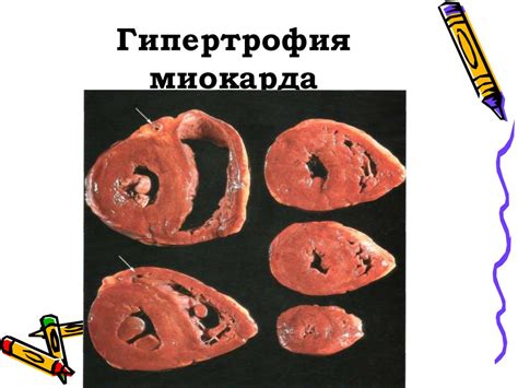 Гипертоническая болезнь - презентация онлайн