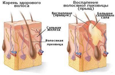 Прыщи на голове и причины появления прыщей в волосах на голове ...