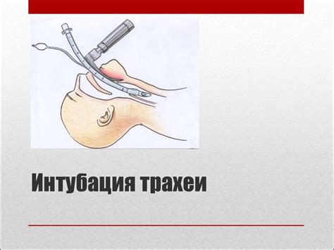 Методы обеспечения проходимости дыхательных путей. Коникотомия ...