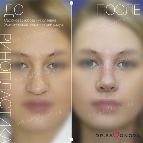 Ринопластика в Санкт-Петербурге - цены на пластику носа в Институте ...