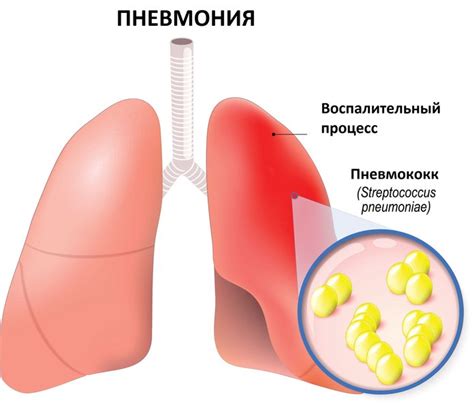 Пневмония: причины развития, симптомы, лечение