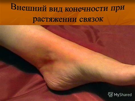 Презентация на тему: "Первая медицинская помощь при растяжении и ...