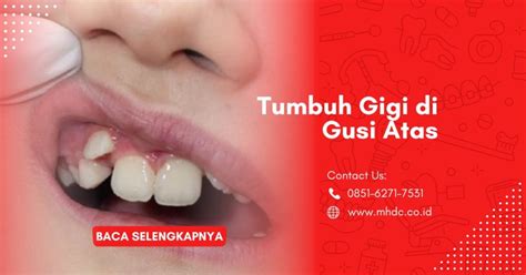 Proses Tumbuh Gigi di Gusi Atas pada Bayi dan Anak