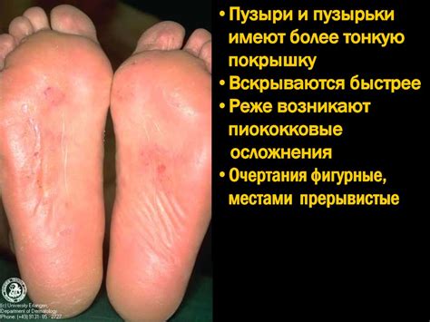 Микозы стоп - презентация онлайн