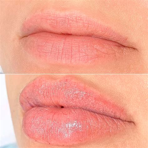 Купить Juvederm Ultra 2 ️ Лучшая цена на филлер Ювидерм Ультра 2 ...