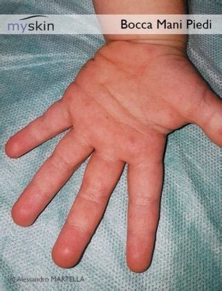 Malattia Bocca Mani Piedi : sintomi e trattamento | Myskin