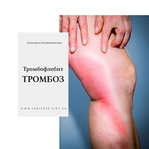 Тромбоз и тромбофлебит поверхностных вен нижних конечностей ⋆ varicose ...