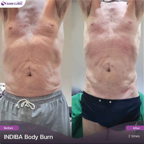 INDIBA Skin Tightening Case Review - Siam Clinic - Aesthetic & Wellness ...